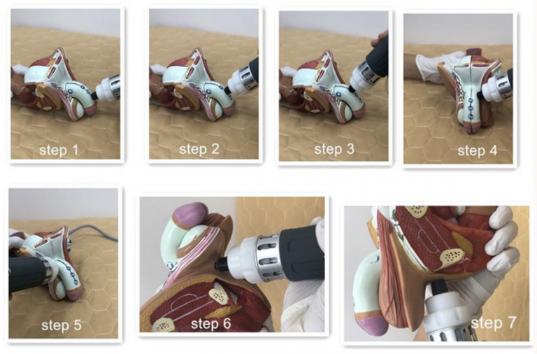 ESWT Extracorporeal Shock Wave Therapy – Suyzeko